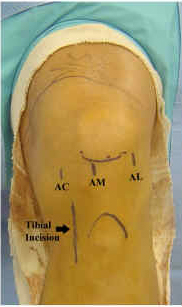 Double Bundle ACL Reconstruction – Orland Park Orthopedics